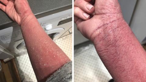 Steroid cream: Women send out warning after severe reactions - BBC News