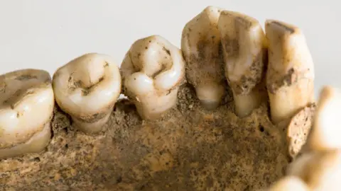 Prehistoric teeth help create historic map of infectious diseases