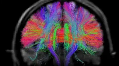 Human 'mini-brains' slow at developing among primates