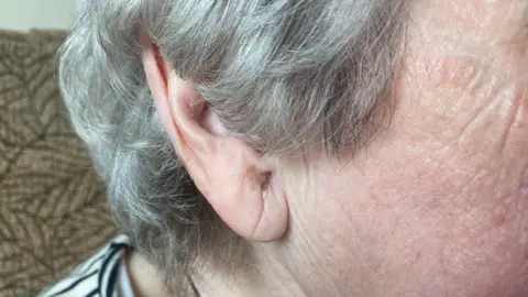 Woman's cancer diagnosis after dentist spots unusual mark on ear