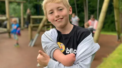 Disability: Support delight for parents of baby with missing limb