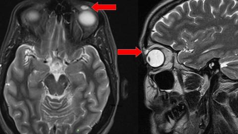 'Lost' contact lens removed from woman's eyelid after 28 years - BBC News