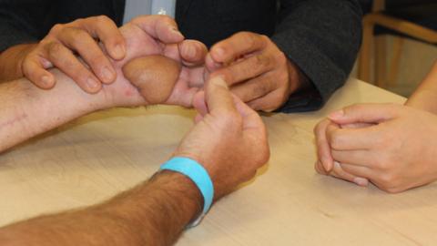 Surgeons save hand severed by electric saw - BBC News