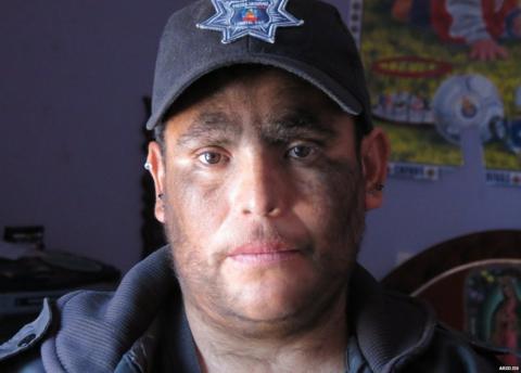 The struggles of the world's hairiest family - BBC News