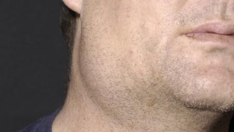 Mumps - is it the forgotten disease? - BBC News