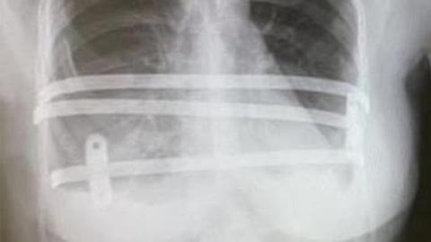 Sunken chest syndrome: NHS U-turn call for 'depressed' patients - BBC News