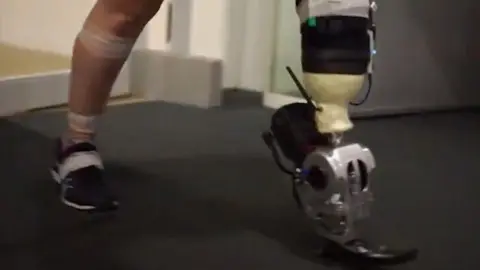 Bionic leg helps amputees walk more naturally