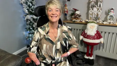 Amputee defies doctors by walking after five years