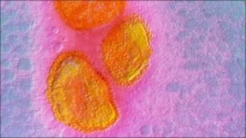 Mumps outbreak hits young people in Oban - BBC News