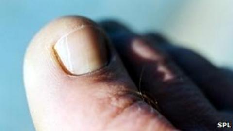 Toenails can reveal lung cancer risk - BBC News