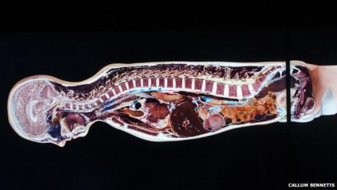 Anatomy students work on life-size virtual cadaver at University of ...