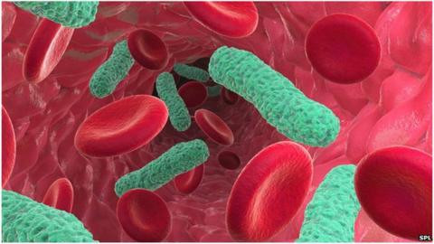 Sepsis: Antibiotics 'not working' - BBC News