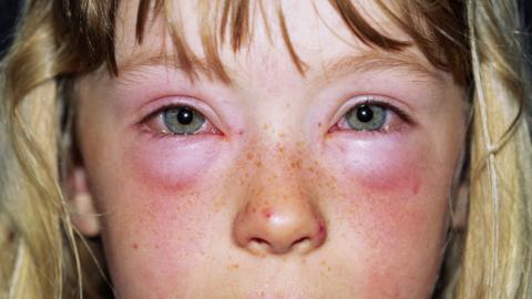 Peanut allergy 'cut by early exposure' - BBC News