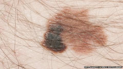 Skin cancer drug fast-tracked on NHS - BBC News