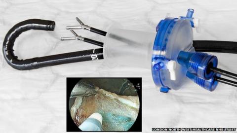 Pioneering surgery 'saves bowels' when removing polyps - BBC News