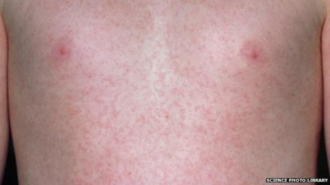Rubella (German measles) eradicated from Americas - BBC News