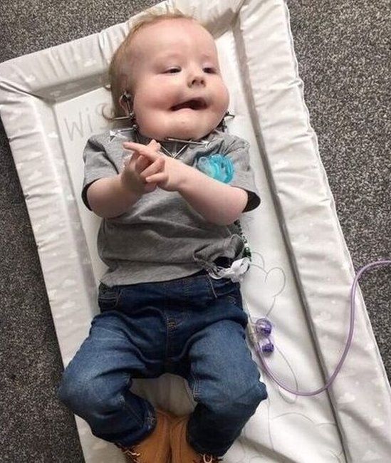 Jaw 'scaffolding' operation helps our baby breathe - BBC News