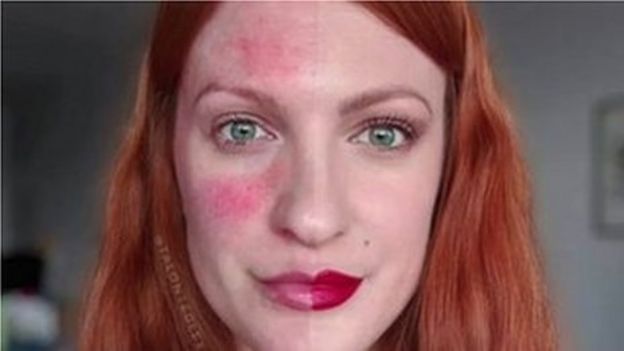Rosacea: 'Your skin doesn't define you' - BBC News