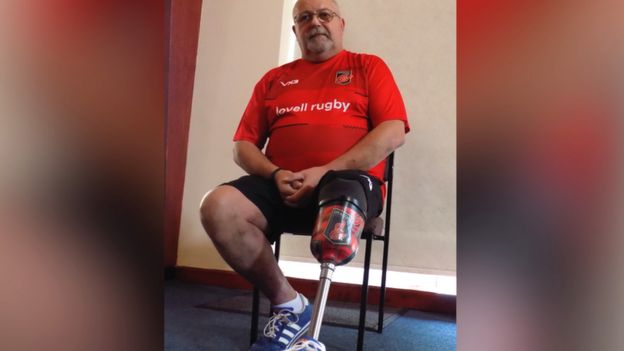 Amputees want more help for limb loss mental anguish - BBC News