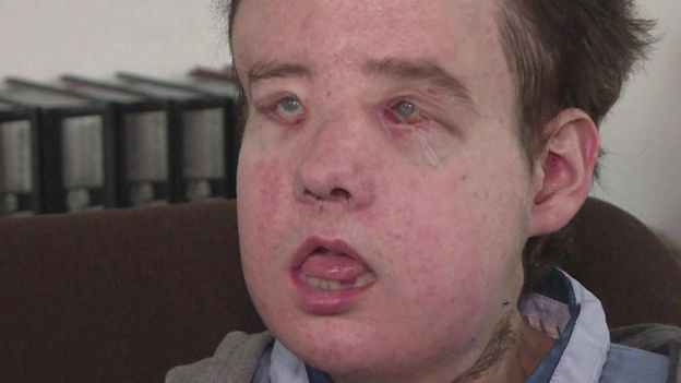 Cameron Underwood: Face transplant means I can smile again - BBC News
