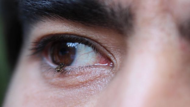 Eye worm infection 'could spread to UK' - BBC News