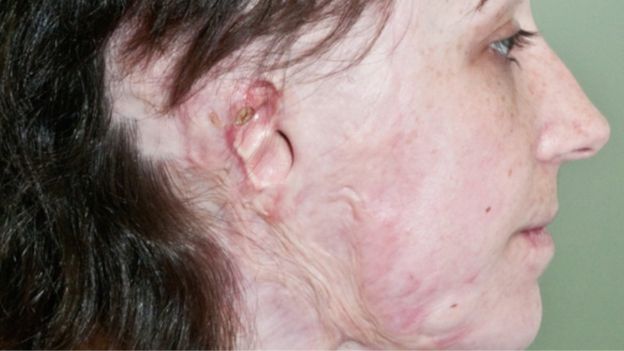 Inside the hospital treating acid attack scars - BBC News