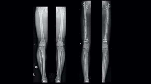 Leg-lengthening: The people having surgery to be a bit taller - BBC News