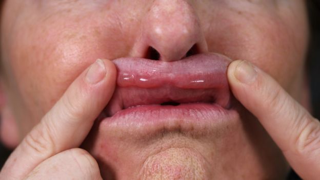 Lockdown Lip Fillers Gone Wrong My Lips Went Black Bbc News