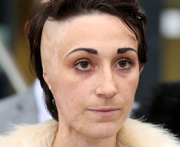 Acid attack victim Adele Bellis plans school talks - BBC News