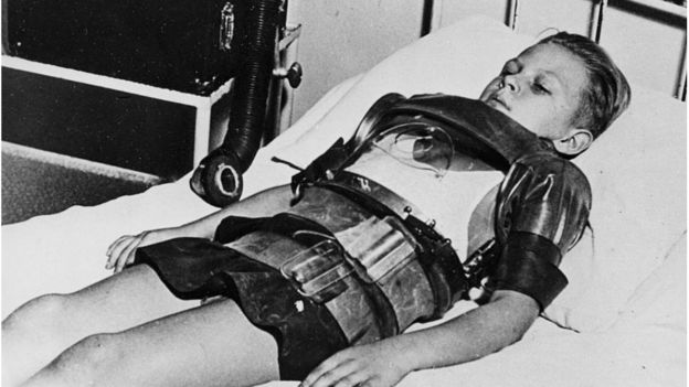 Polio: memories of self-isolation in the 1950s - BBC News