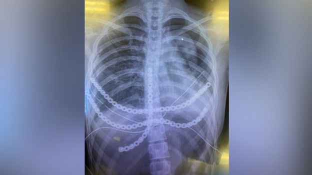 Sunken chest syndrome: Stranger pays for teenager's surgery - BBC News