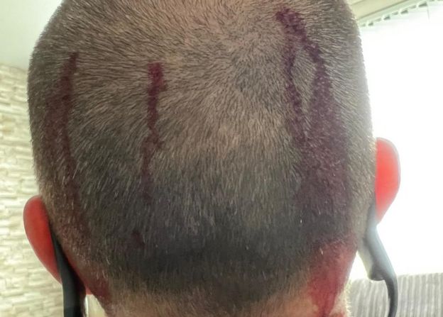 Buzzard attacks leave runners with six holes in head - BBC News