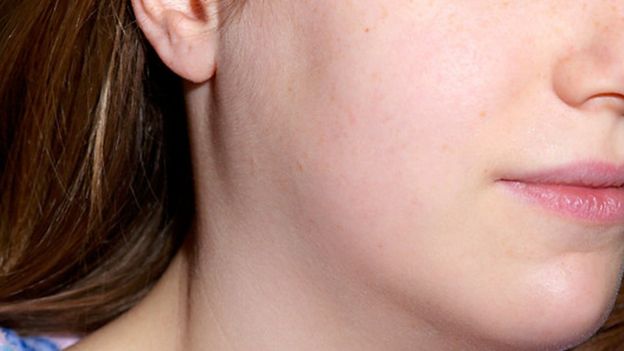 Mumps - is it the forgotten disease? - BBC News