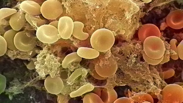 La drépanocytose en Afrique : les défis d'une meilleure prise en charge ...