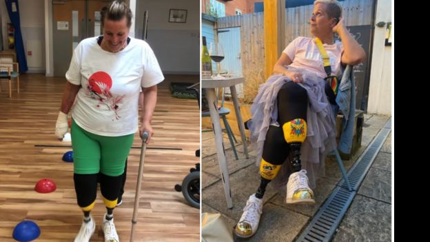 Sepsis victim warns of silent symptoms after losing both legs - BBC News