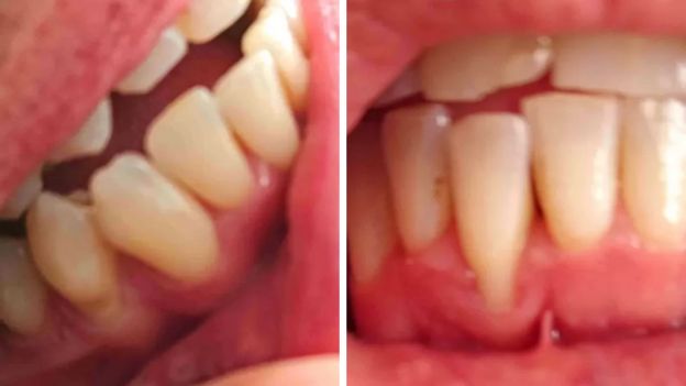 Dentists warn of permanent damage from clear braces ordered online ...