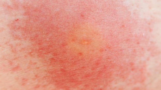 O que é inflamação e por que às vezes ela é perigosa - BBC News Brasil