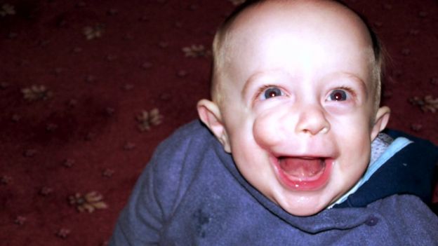 The children living with facial disfigurements - BBC News