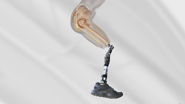 Amputee ex-soldier's pioneering leg implant - BBC News