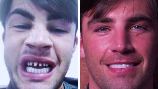 Turkey teeth: Are cut-price reality TV teeth worth it? - BBC News