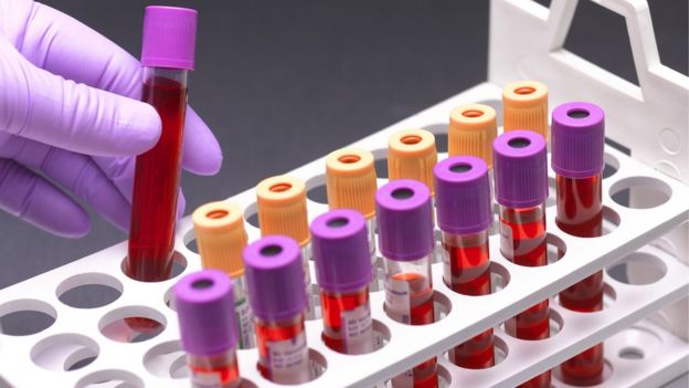 Multi-cancer blood test shows real promise in NHS study - BBC News