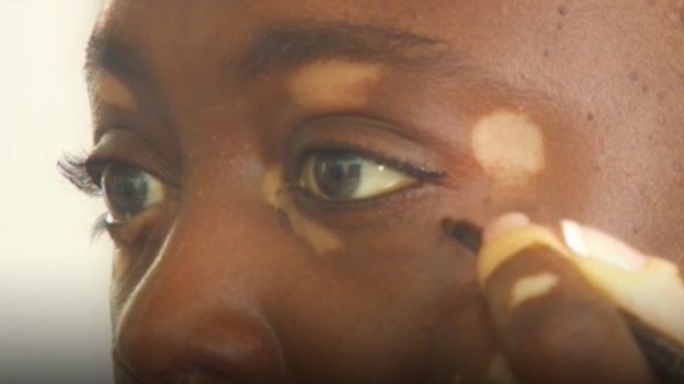 Vitiligo: The shame and stigma in South Asian communities - BBC News