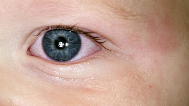 Eye burn injuries risk to children from liquitabs 'on the rise' - BBC News