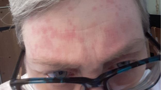 Latex allergy: 'A balloon could kill me' - BBC News