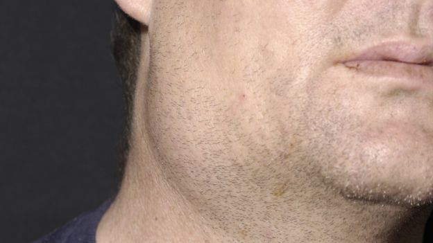 Mumps - is it the forgotten disease? - BBC News