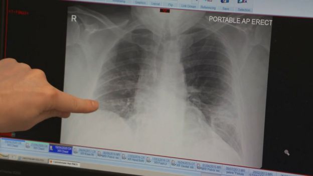 Why your health may never be the same after Covid-19 - BBC News