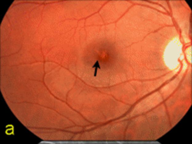 Laser pointers 'pose danger to eyes' - BBC News