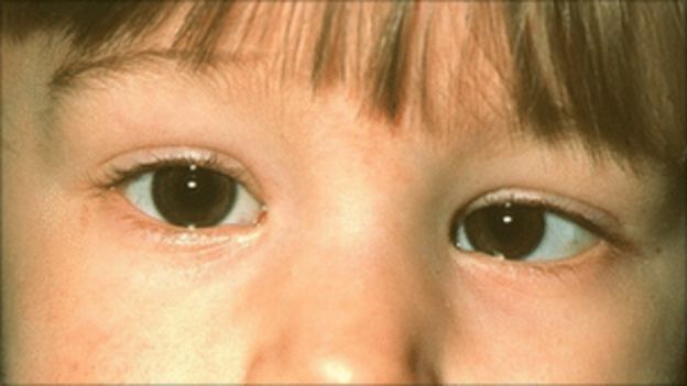 Squinters 'refused party invites' - BBC News