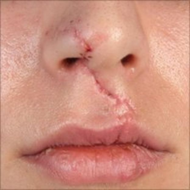 Woman scarred by glassing attack in Swindon nightclub - BBC News