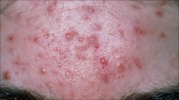 Acne drug not found to increase suicide risk - BBC News